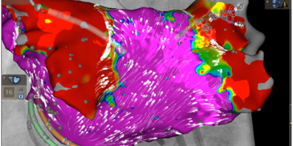 Neue Therapie für Herzrhythmusstörungen: Europapremiere in der Asklepios Klinik Altona